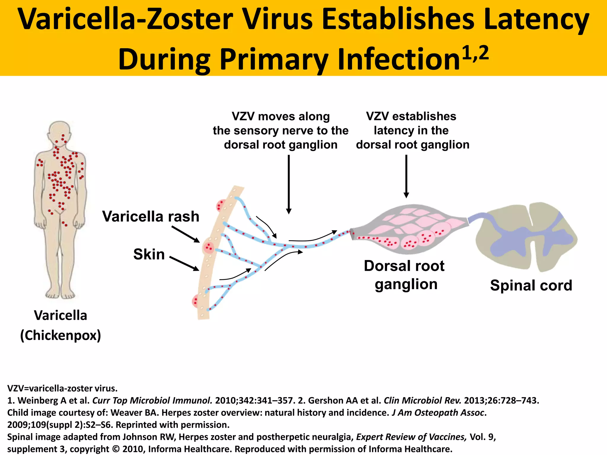 ABC of PREVENTION HERPES ZOSTER IN ADULT WOMEN | PPTX