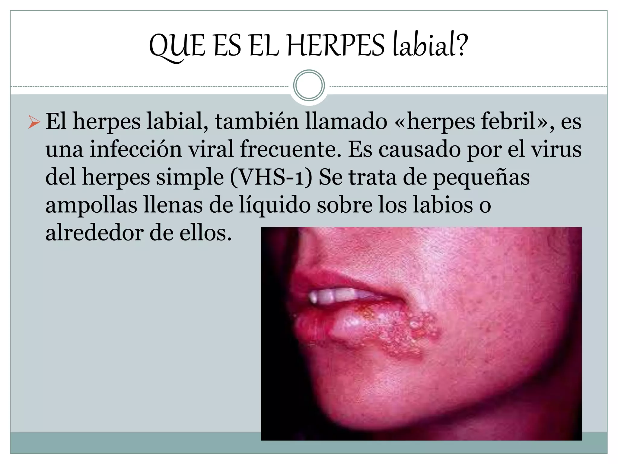 Herpes genital dfp | PPT