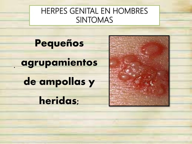 Herpes genital en hombres sintomas | PPT