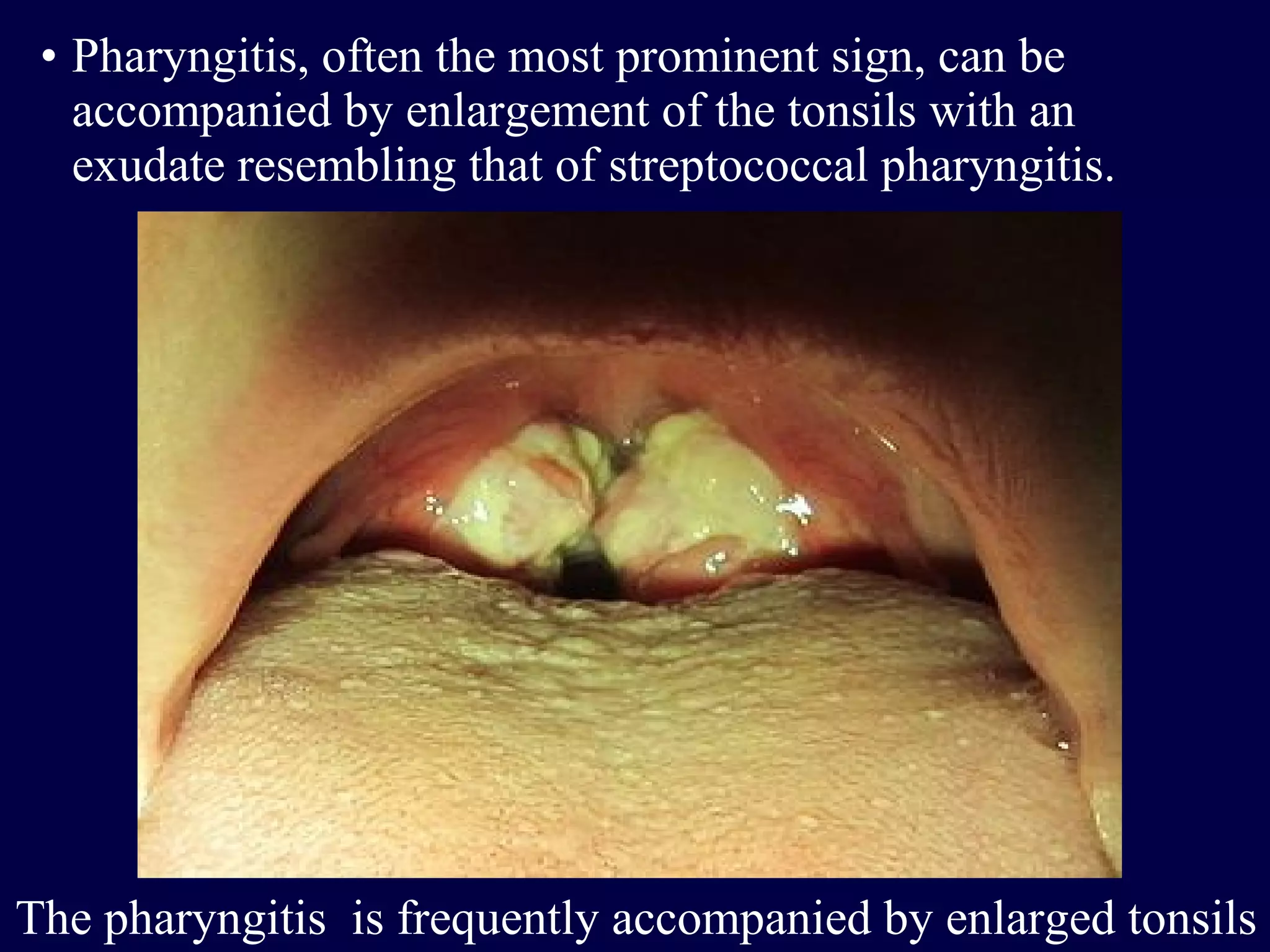 Human Herpesviruses INFECTIOUS MONONUCLEOSIS 2016 | PPT