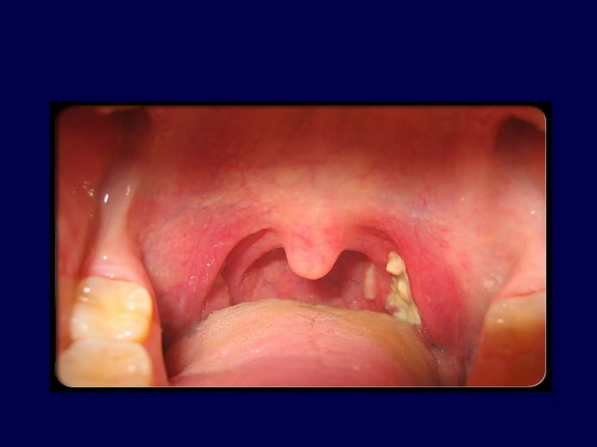 Human Herpesviruses INFECTIOUS MONONUCLEOSIS 2016 | PPT