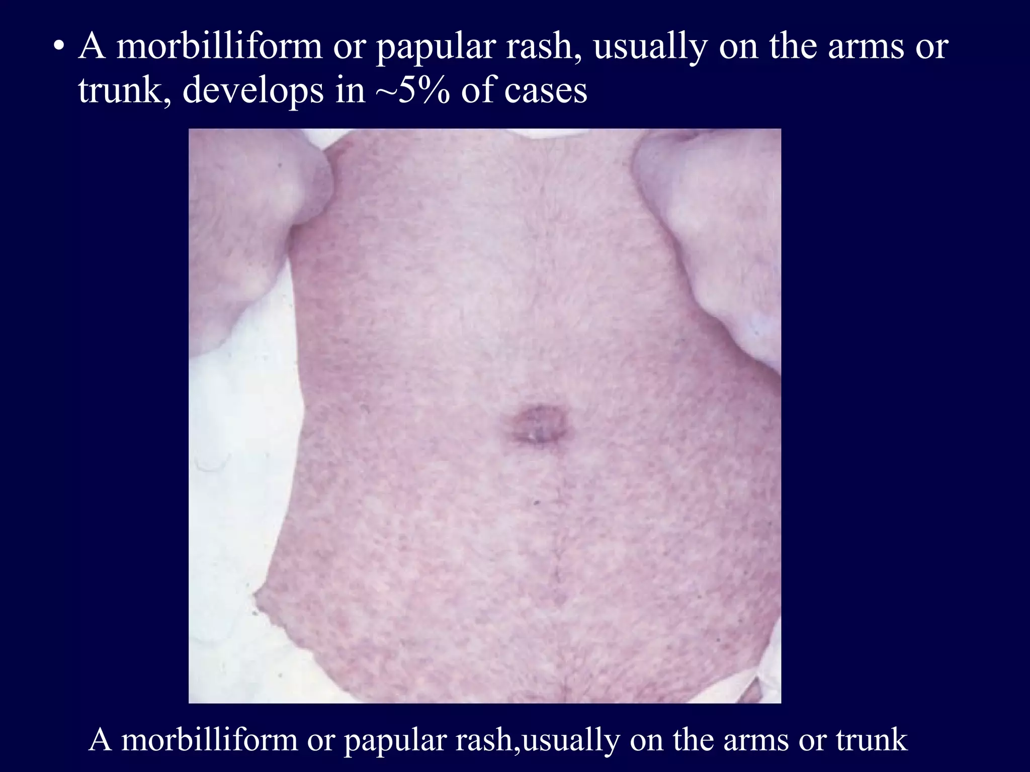 Human Herpesviruses INFECTIOUS MONONUCLEOSIS 2016 | PPT