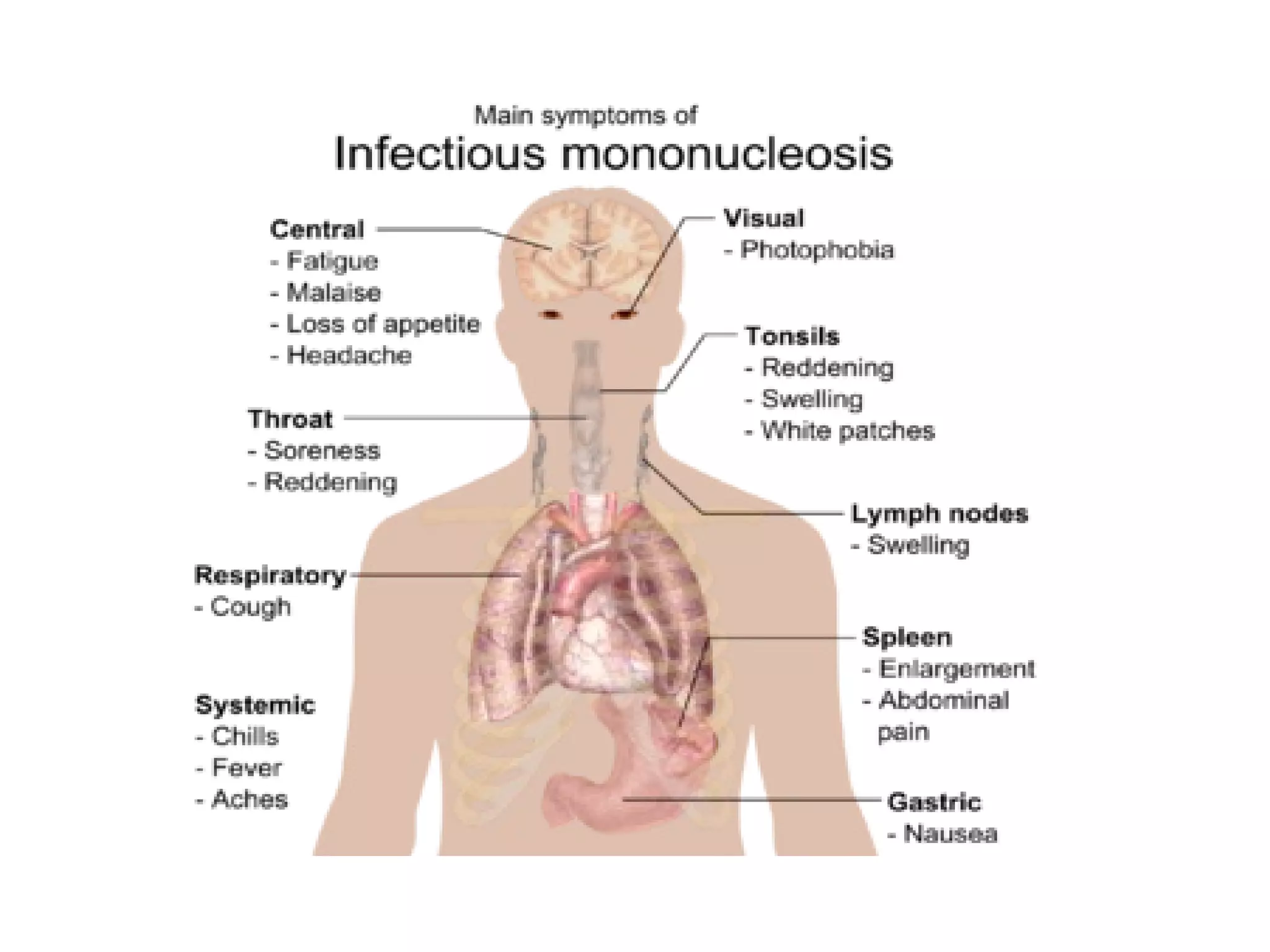 Human Herpesviruses INFECTIOUS MONONUCLEOSIS 2016 | PPT
