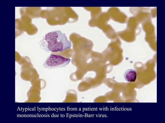 Human Herpesviruses INFECTIOUS MONONUCLEOSIS 2016 | PPT