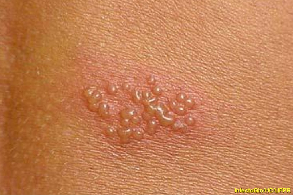 Herpes its 2011atualizado