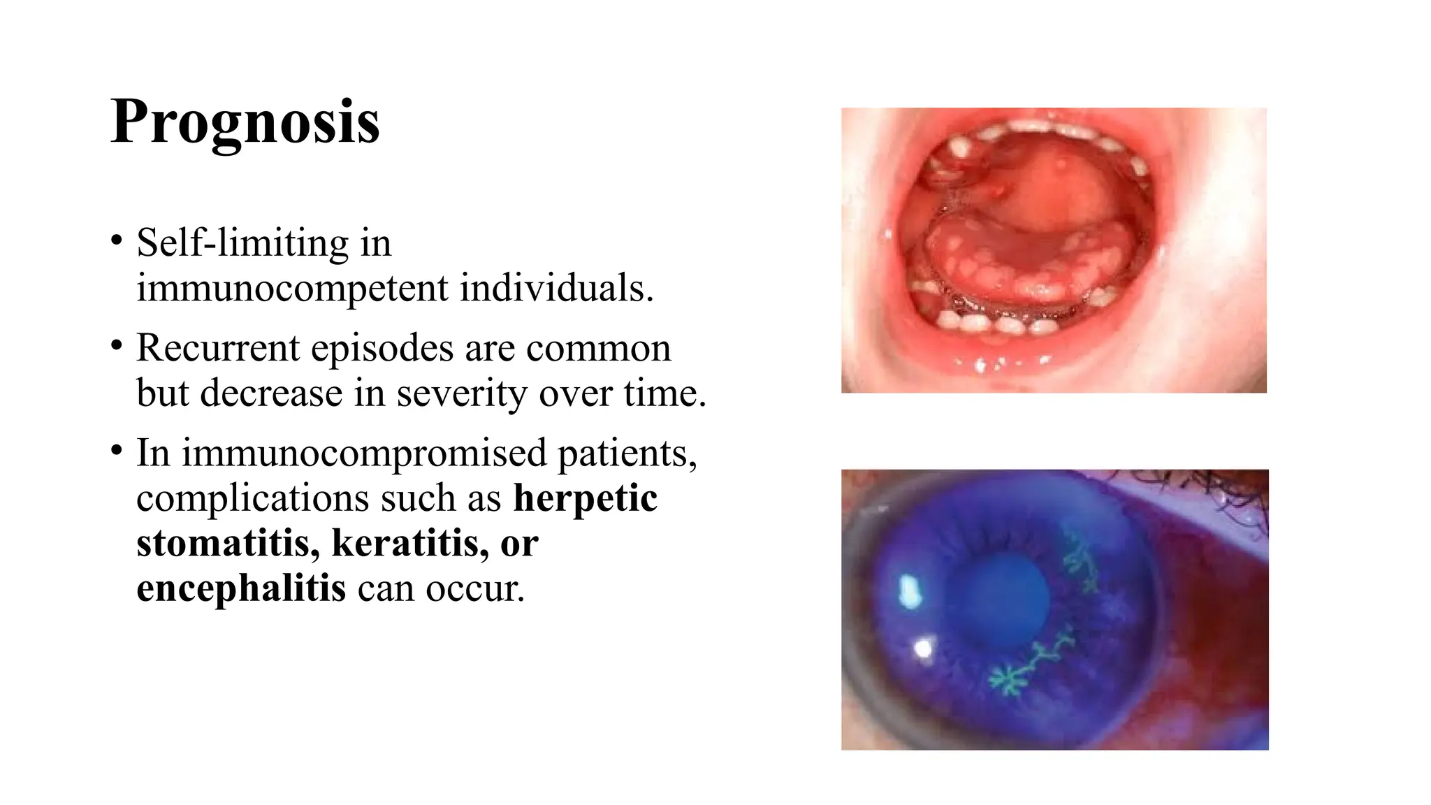 Herpes Labialis : Understanding pathophysiology, Clinical features and treatment | PPT