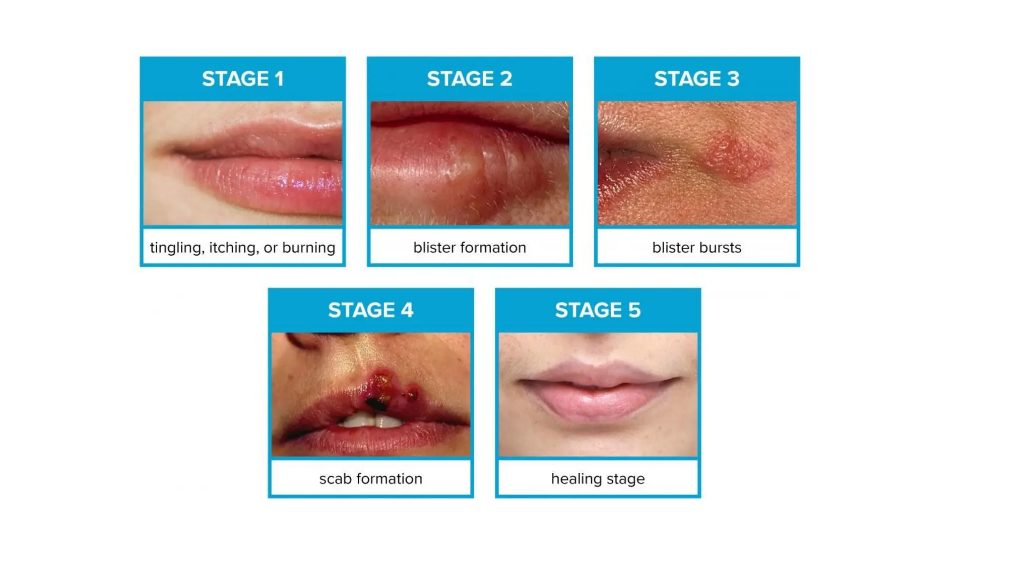 Herpes Labialis : Understanding pathophysiology, Clinical features and treatment | PPT