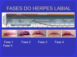 Herpes (seminário) | PPT