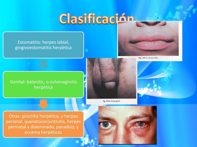 Herpes simple | PPT