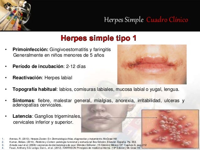 Herpes simple