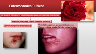Herpes simple | PPTX