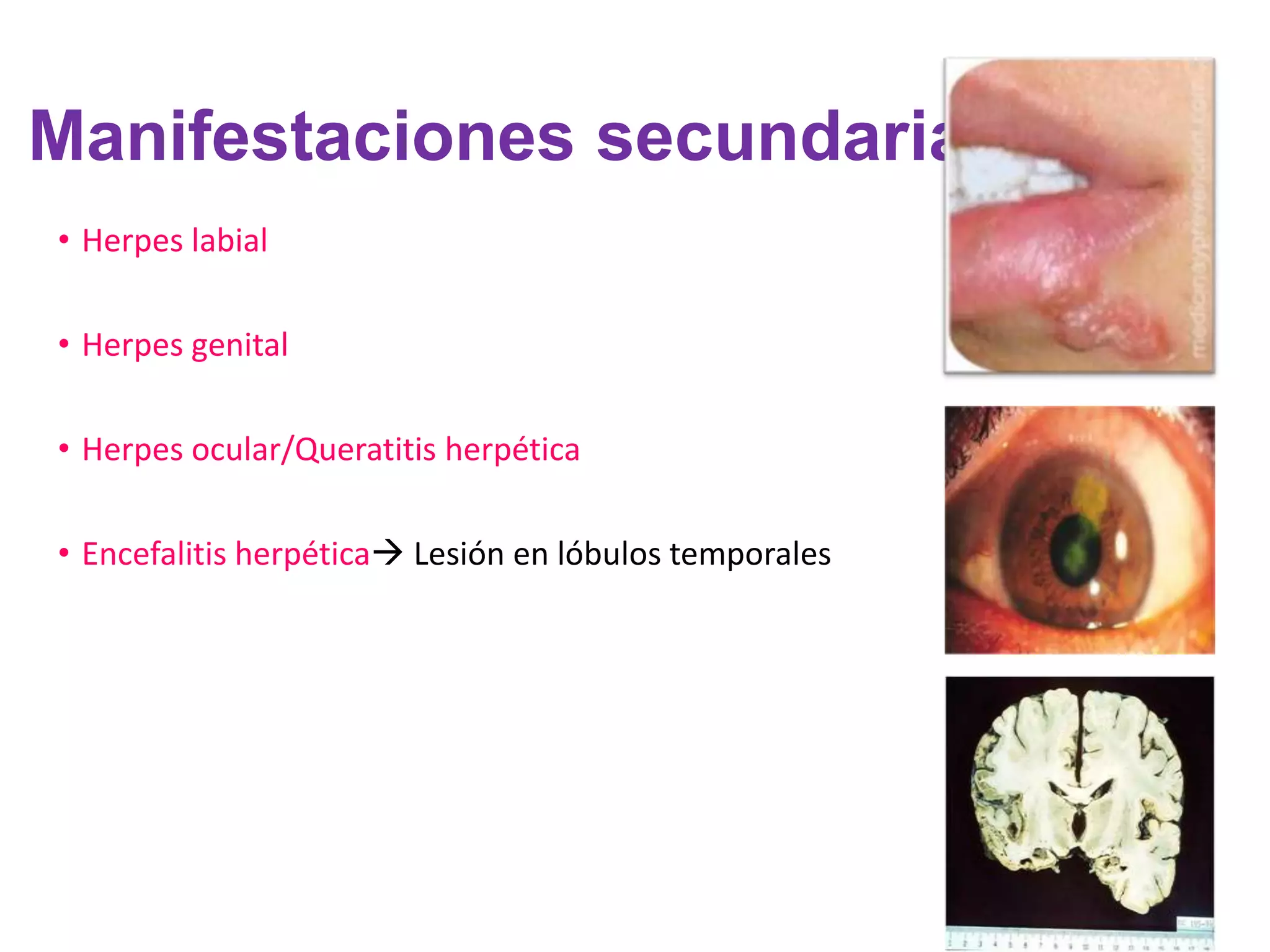 Herpes simple (1) | PPT
