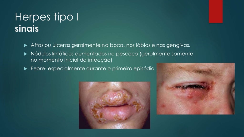 Herpes simples