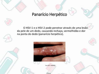 HERPES SIMPLES editado (2).pptx