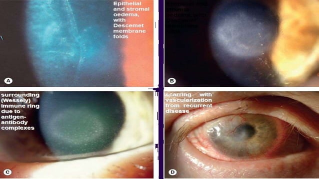 Herpes Simplex keratitis by Dr. Muhammad Zeeshan Hameed | PPT