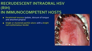 Intraoral Herpes