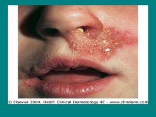 Herpes simplex.ppt