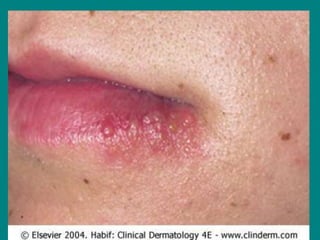 Herpes simplex.ppt
