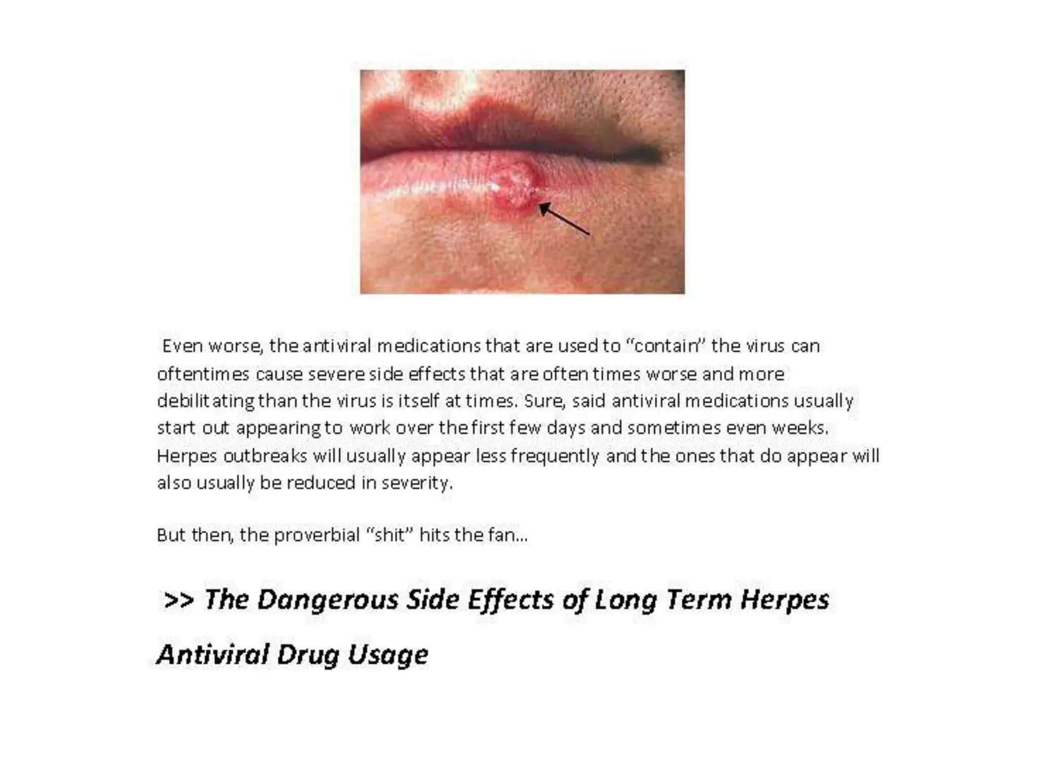 Herpes Simplex 1 | PPT