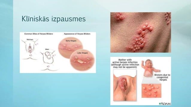 Herpes simplex 2 | PPTX