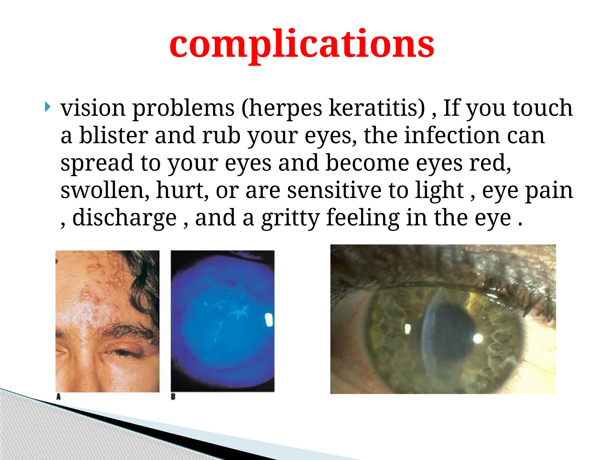 Herpes Simplex and Herpes Zoster-1.ppt jd | PPTX