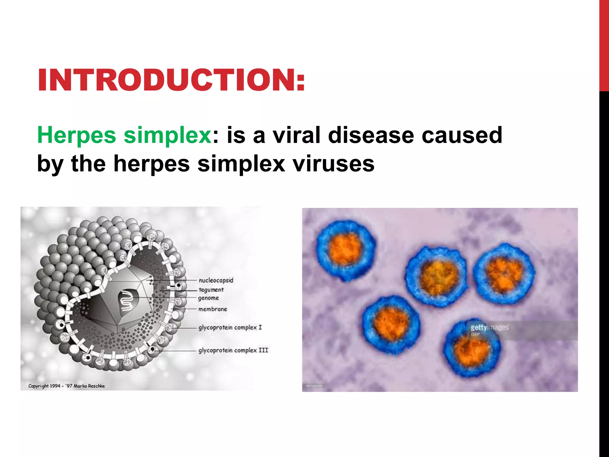 Herpes simplex infection(Hsv) | PPTX