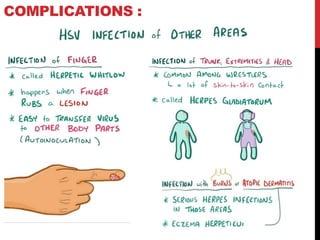 Herpes simplex infection(Hsv) | PPTX