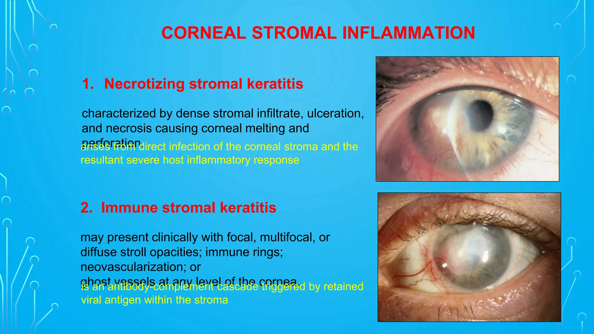 Herpes Simplex Keratitis .pptx | Eye and Vision Conditions | Diseases ...