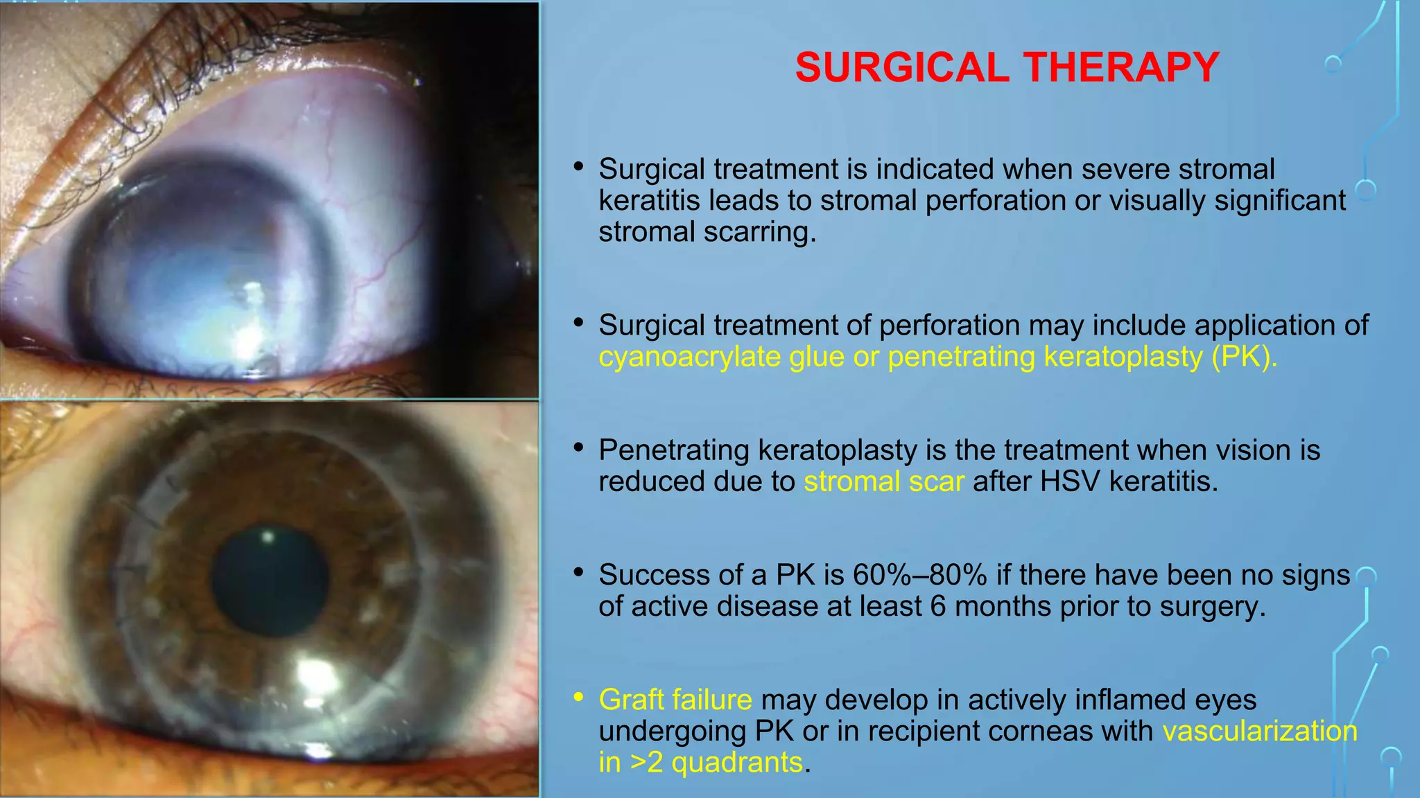 Herpes Simplex Keratitis .pptx | Eye and Vision Conditions | Diseases ...