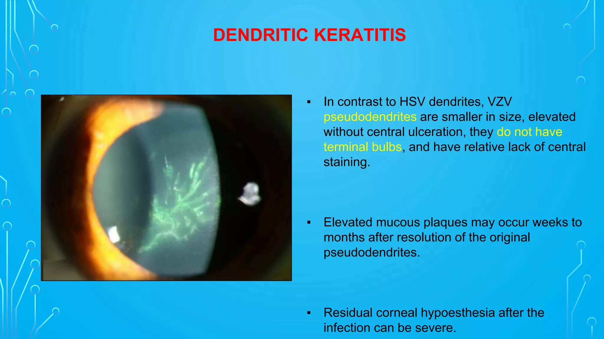 Herpes Simplex Keratitis .pptx | Eye and Vision Conditions | Diseases ...