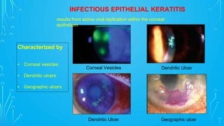 Herpes Simplex Keratitis .pptx