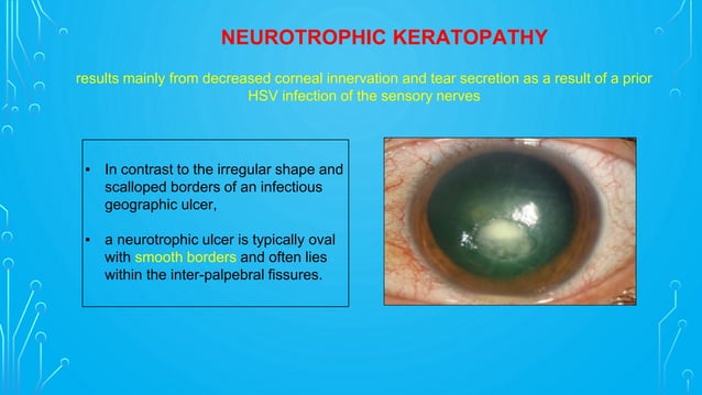 Herpes Simplex Keratitis .pptx | Eye and Vision Conditions | Diseases ...