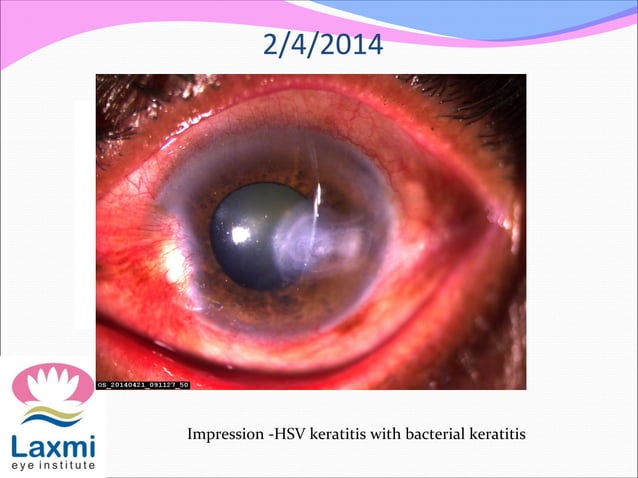 Herpes simplex keratitis & herpes zoster opthalmicus | PPT