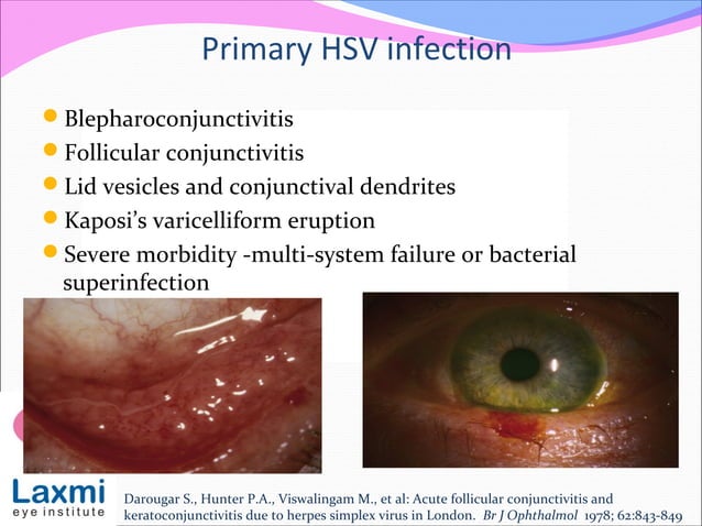Herpes Simplex Keratitis Herpes Zoster Opthalmicus Ppt