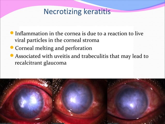 Herpes Simplex Keratitis Herpes Zoster Opthalmicus Ppt
