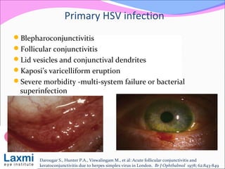 Herpes Conjunctivitis Dendritic
