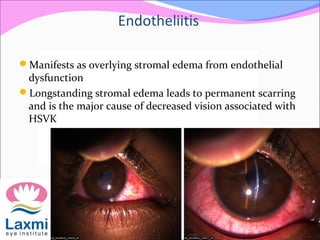 Disciform Endotheliitis