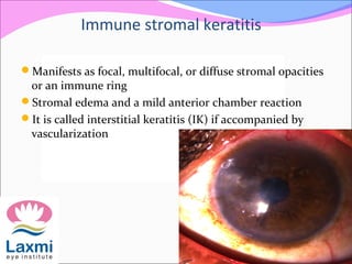 Stromal Keratitis