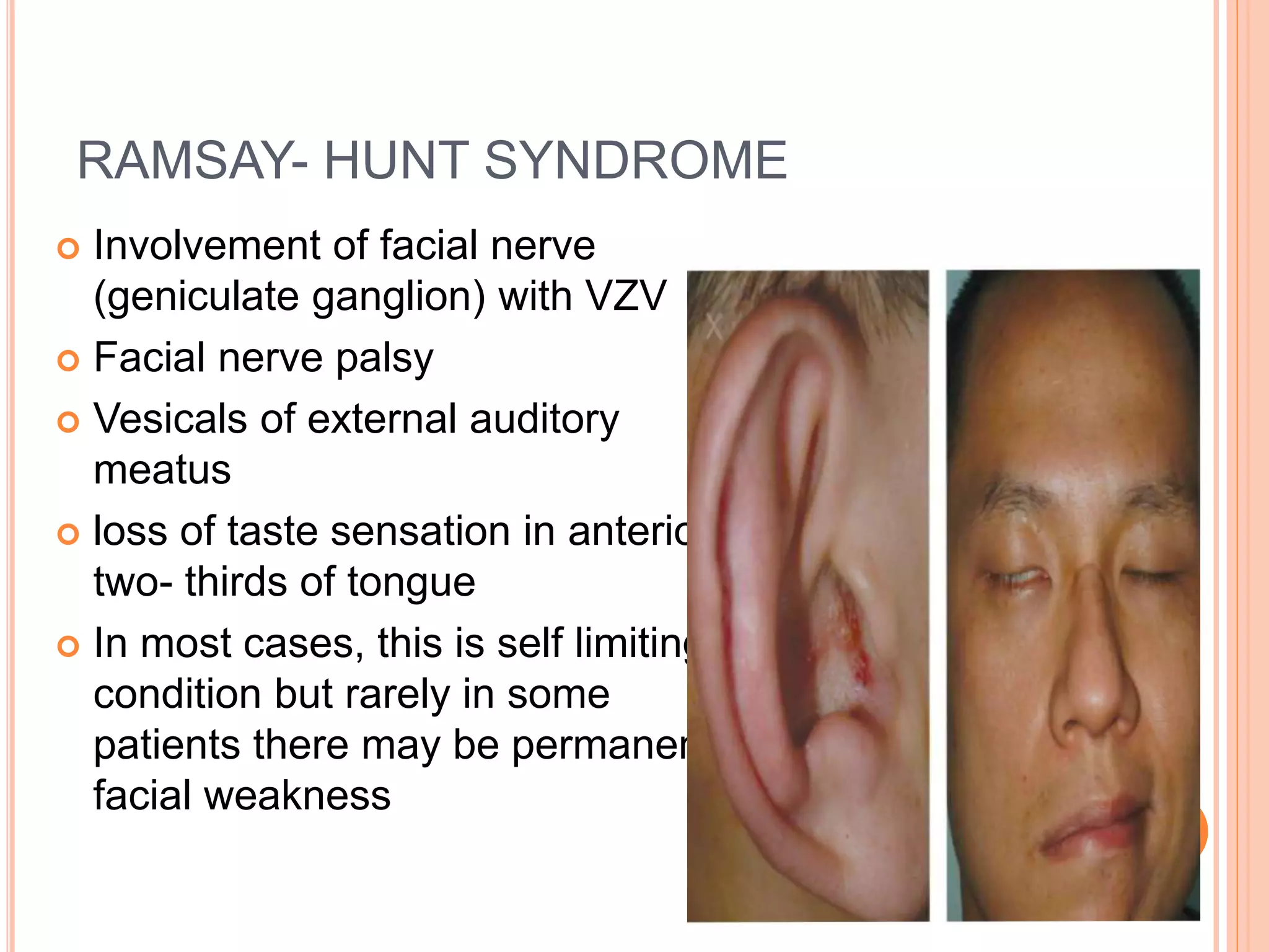 Herpes simplex virus, classification, clinical findings, oral ...