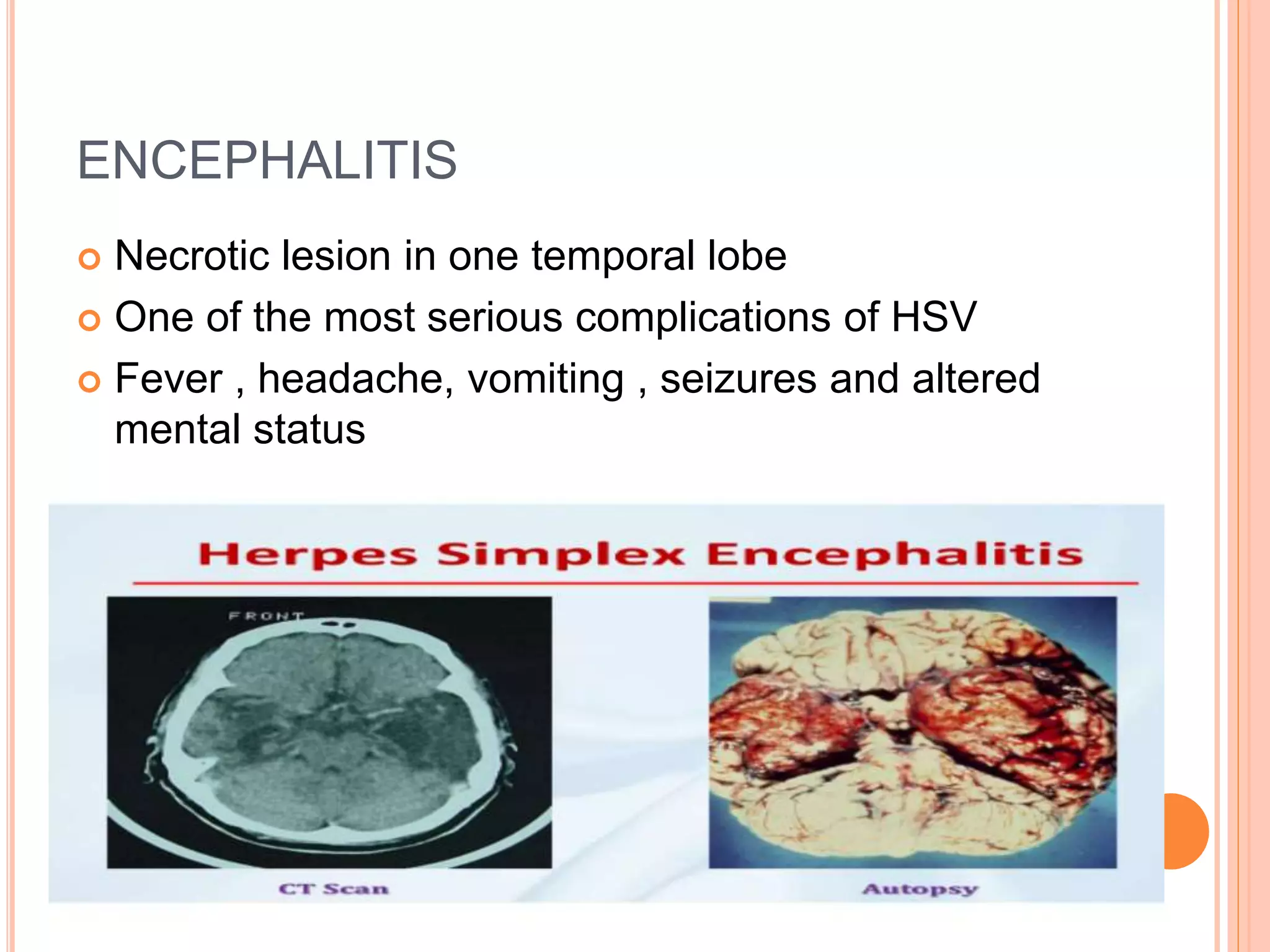 Herpes simplex virus, classification, clinical findings, oral ...