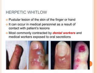 Herpes simplex virus, classification, clinical findings, oral ...