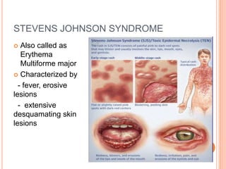 Herpes simplex virus, classification, clinical findings, oral ...