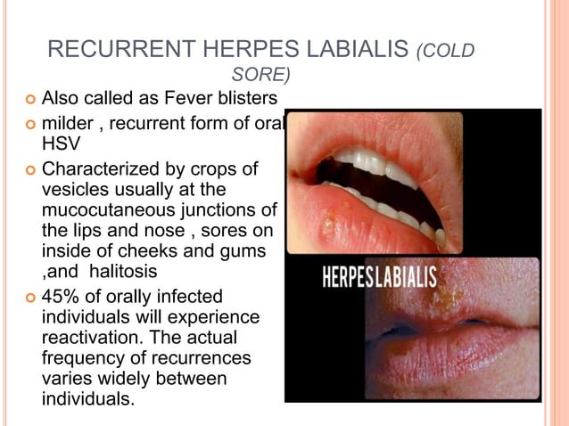Herpes simplex virus, classification, clinical findings, oral ...
