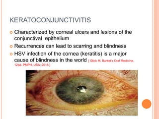 Herpes simplex virus, classification, clinical findings, oral ...