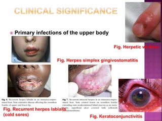 Recurrent Herpes Labialis