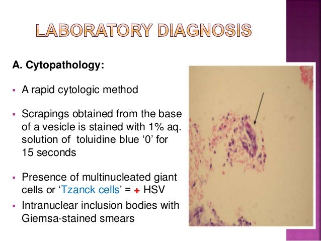Herpes simplex virus