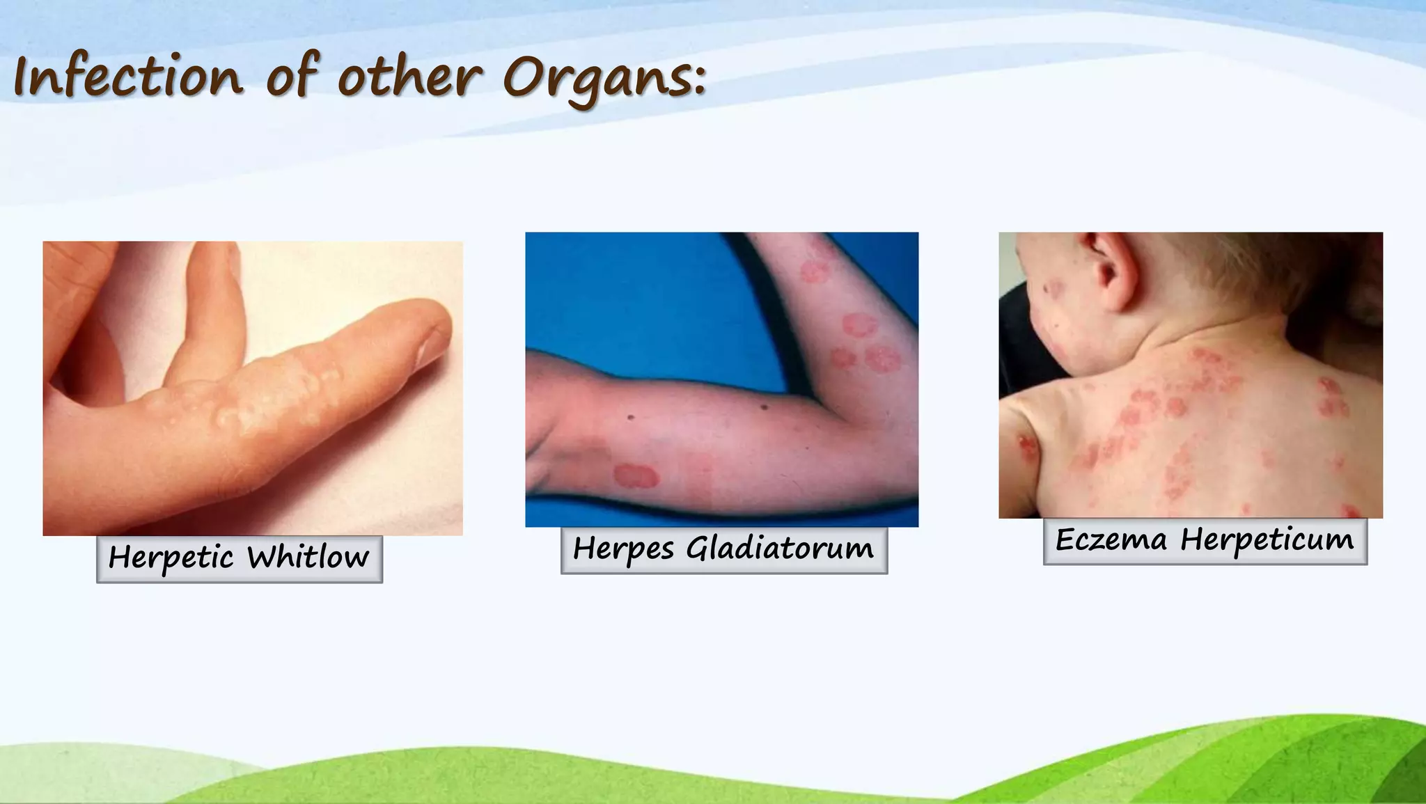 Herpes simplex virus | PPTX