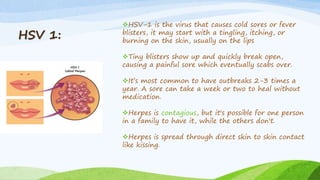 Herpes simplex virus | PPTX