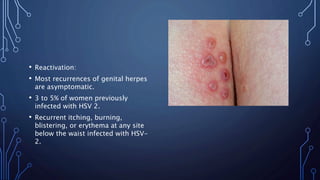 Herpes simplex virus Type 1 and Type 2 | PPTX