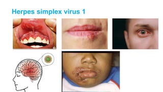 Herpes simplex virus 1 and 2 (HSV 1 and 2)) | PPTX